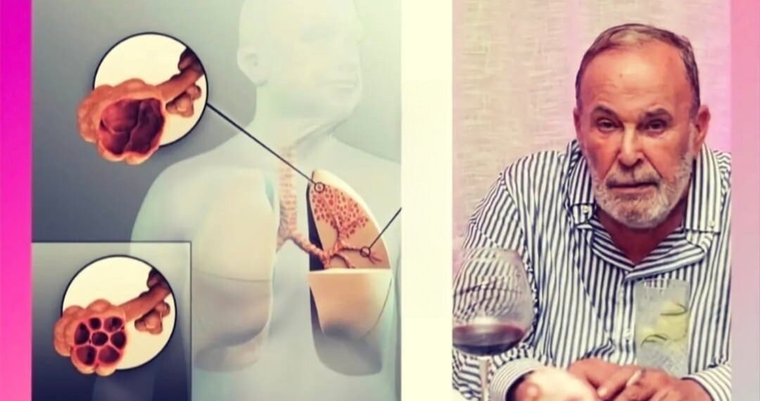 Çfarë është ‘SPOK’, sëmundja e pashërueshme që i mori jetën Fatos Nanos ...